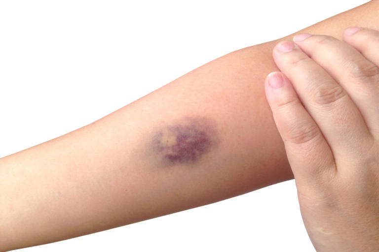 Quanto dura un livido