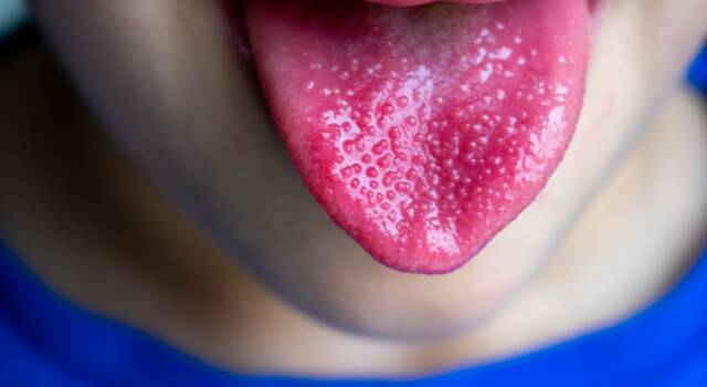 Scarlattina nei bambini: cause, sintomi e diagnosi della malattia